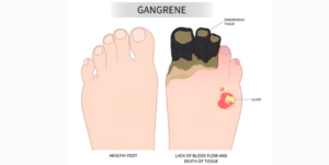 Gangrene Foot - Causes, Symptoms, and Treatments